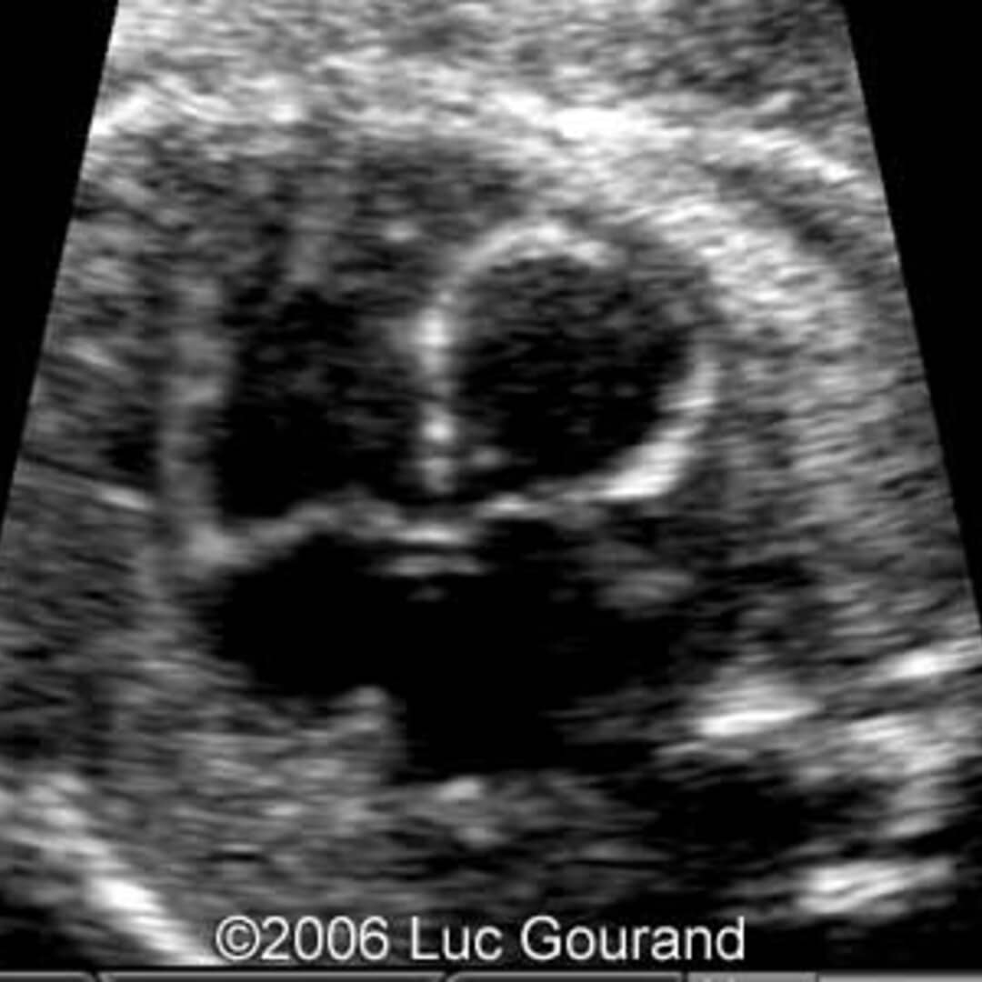 📃 Endocardial fibroelastosis