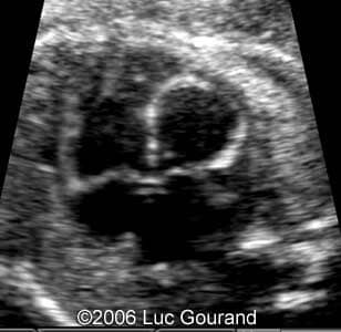 📃 Endocardial fibroelastosis