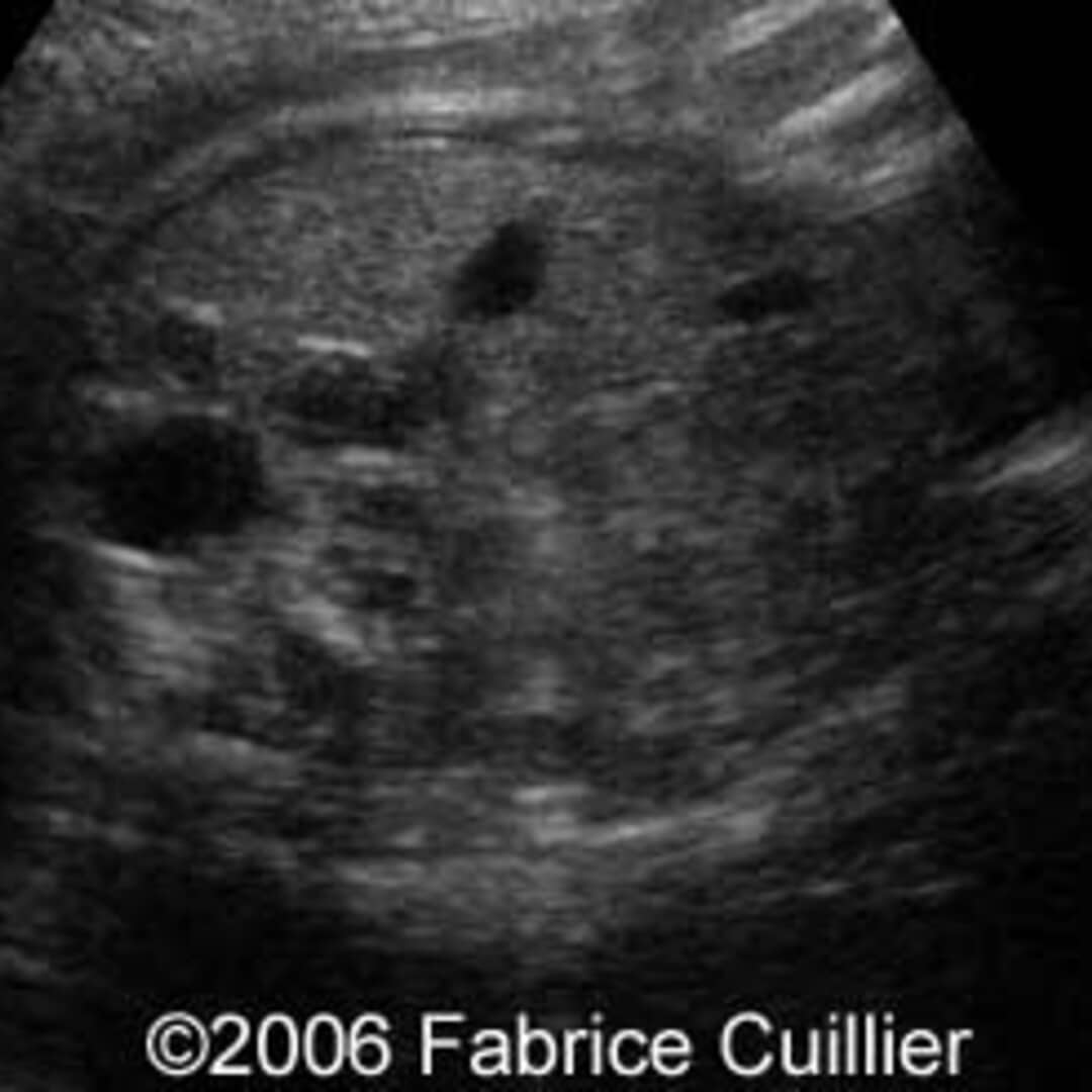 📃 Multicystic kidney disease, unilateral