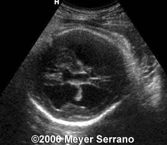📃 Walker-Warburg syndrome