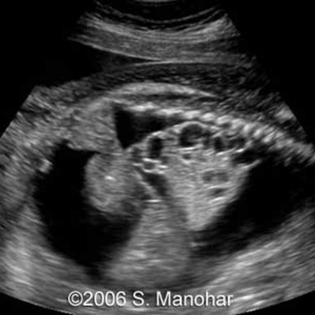 📃 Congenital cystic adenomatoid malformation of the lung, type II.