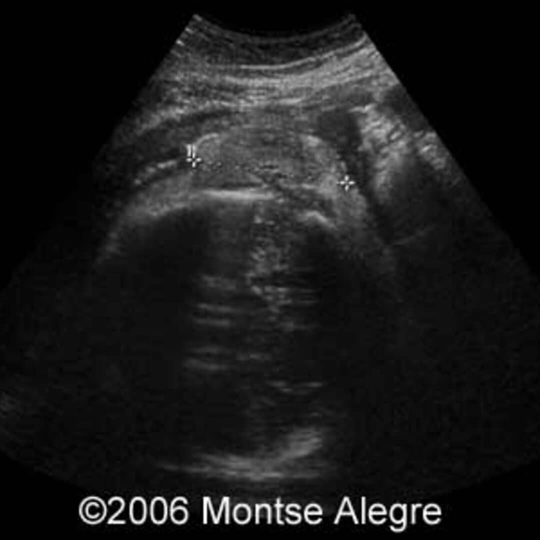 📃 Hemangioma, rapidly involuting