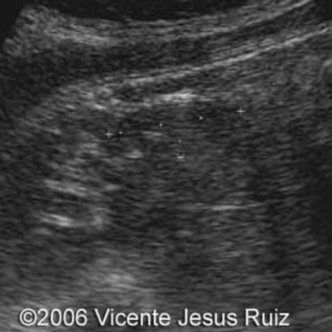 📃 Bilateral renal agenesis