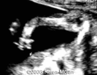 📃 Acromesomelic dysplasia