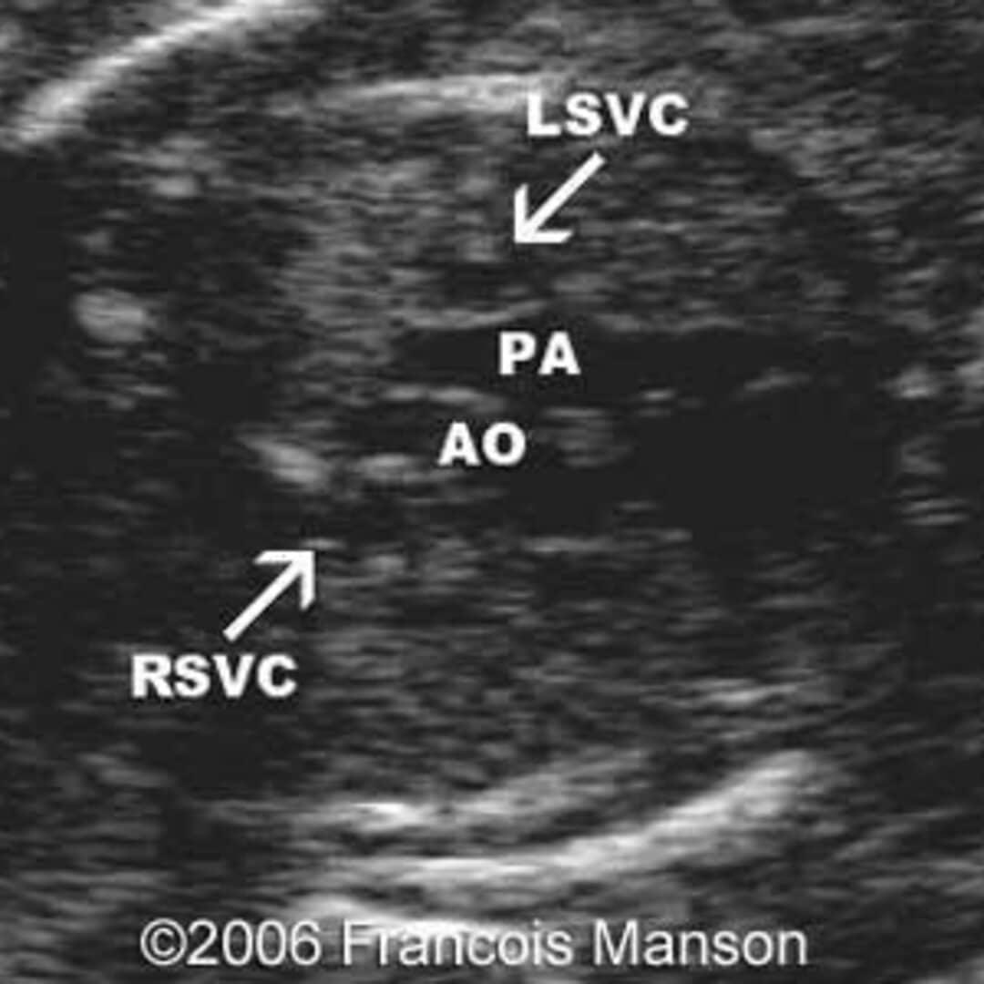 📃 Persistent left superior vena cava