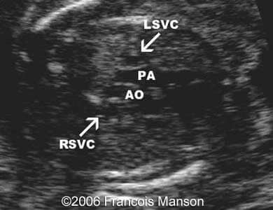 📃 Persistent left superior vena cava