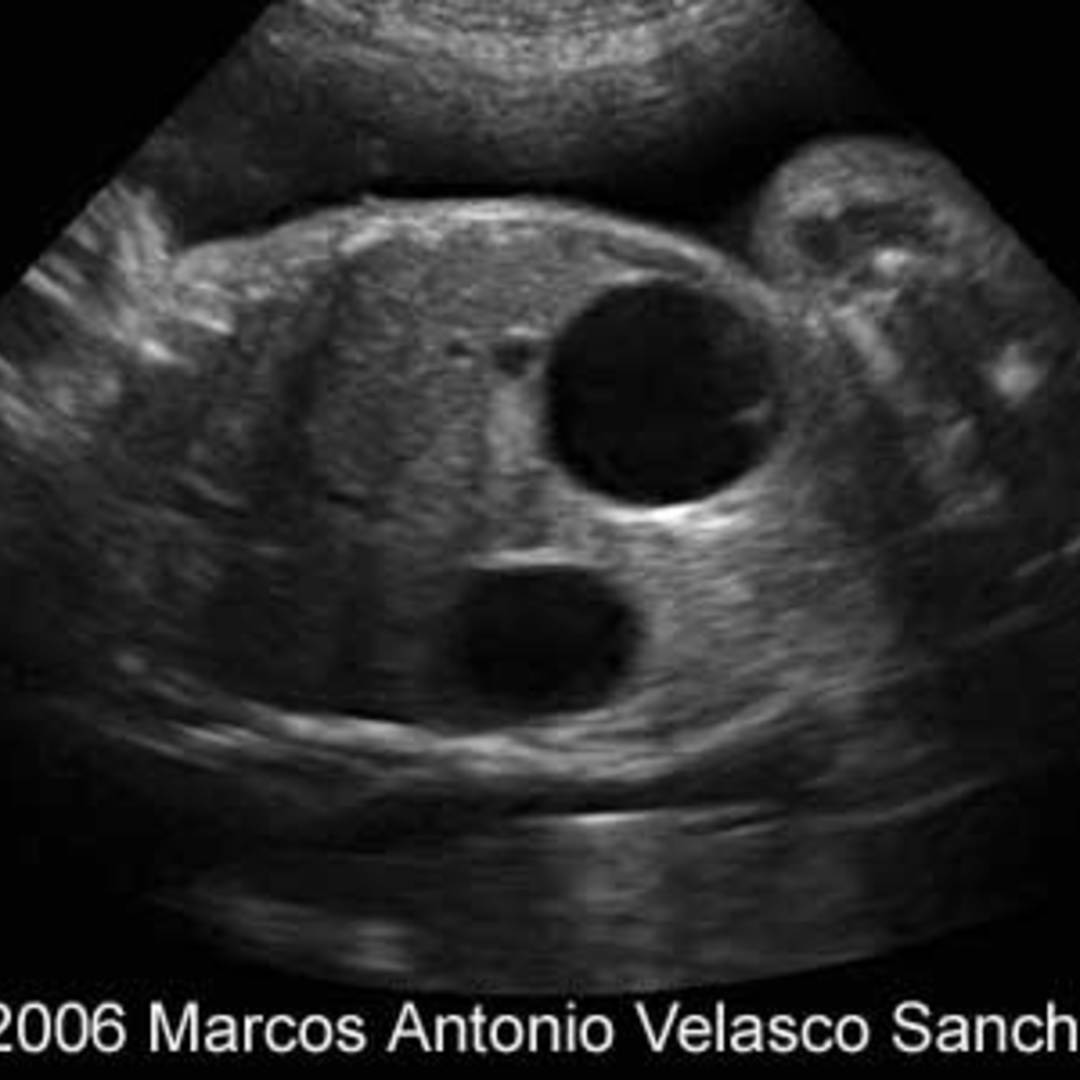 📃 Duodenal Atresia Male