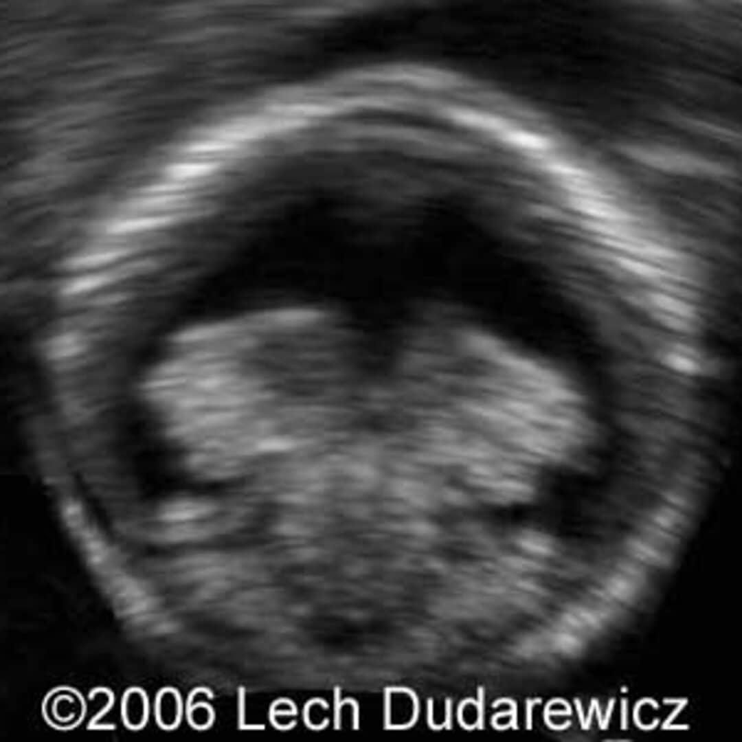 📃 Holoprosencephaly, semilobar