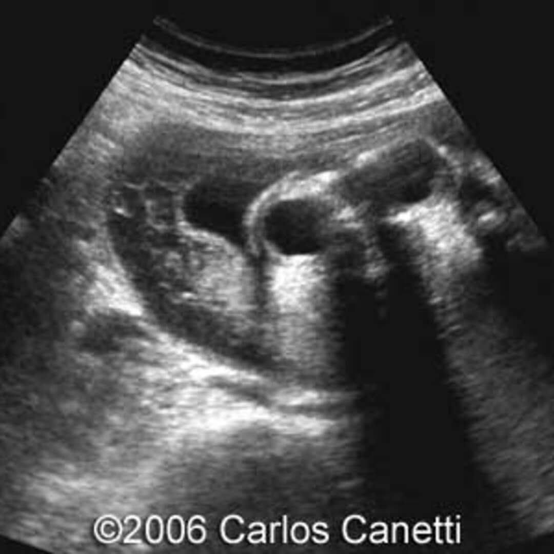 📃 Anencephaly