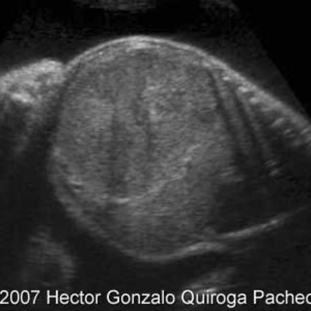 📃 Mesoblastic nephroma