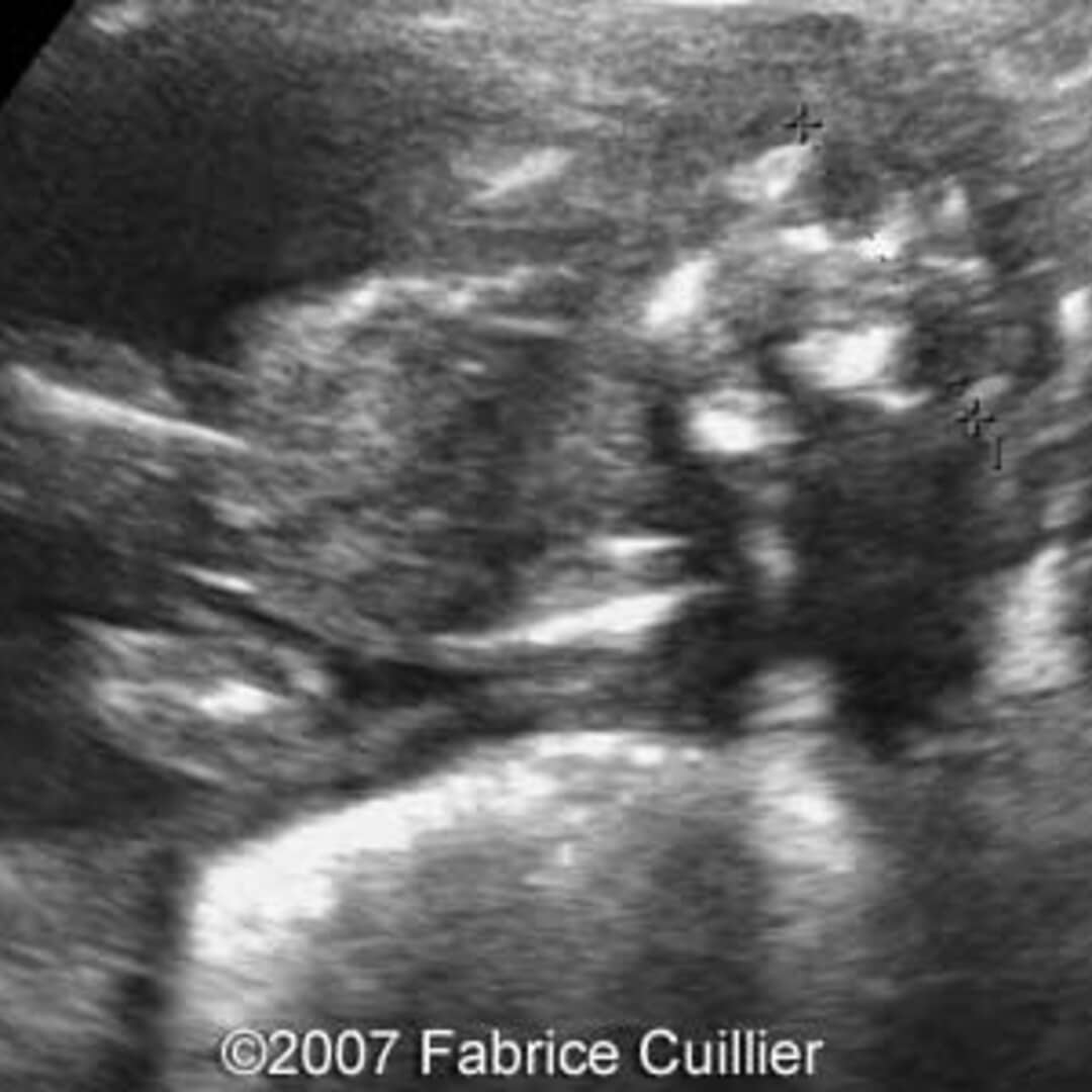 📃 Anencephaly, acrania