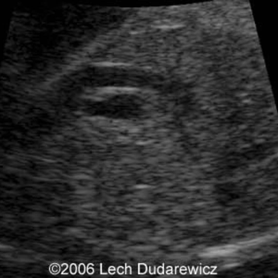 📃 Persistent right umbilical vein