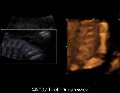 📃 Hemimelia, transverse
