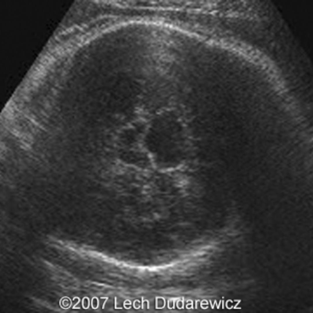 📃 Arachnoid Cyst Suprasellar