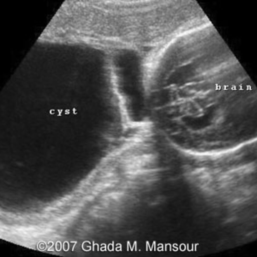 📃 Cranial meningocele