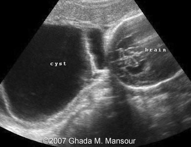 📃 Cranial meningocele