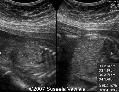 📃 Infantile polycystic kidney disease, autosomal recessive