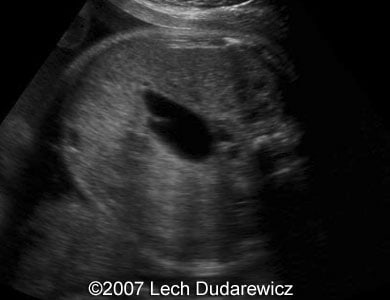 📃 Choledochal cyst