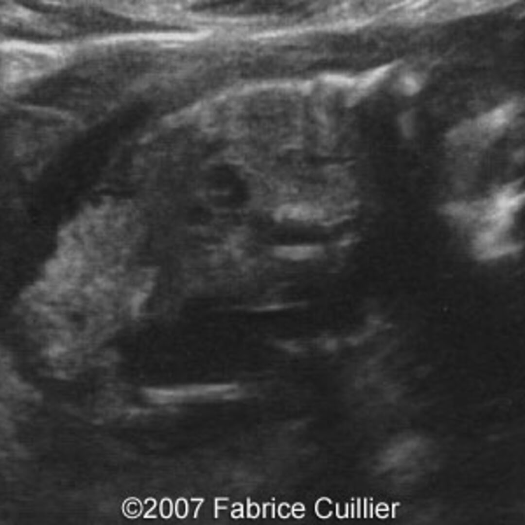 📃 Limb body wall complex, 15 weeks of gestation