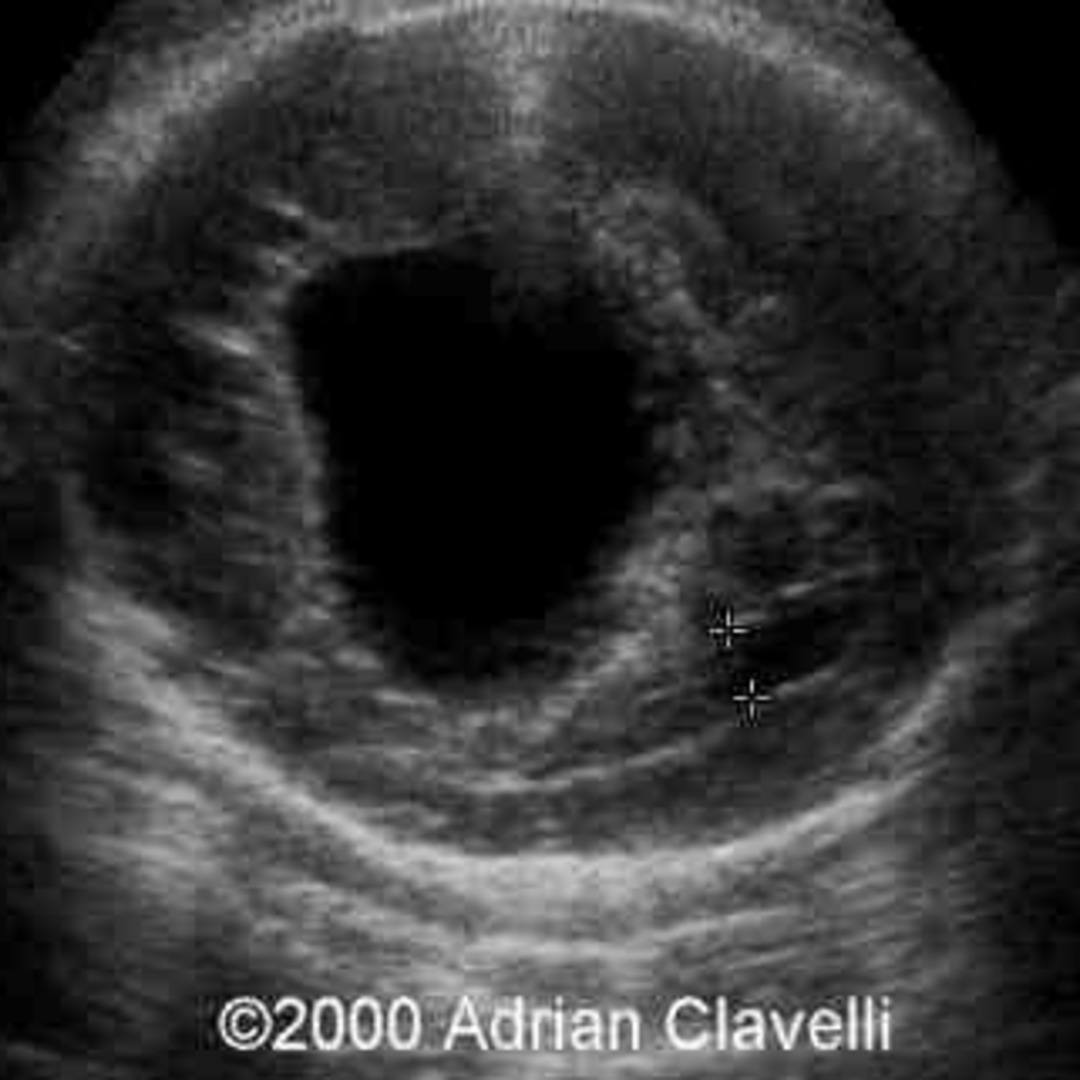 📃 Arachnoid Cyst