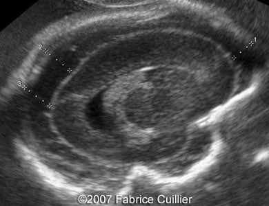 📃 Microcephaly with abnormal gyral pattern
