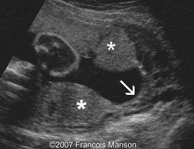 📃 Low-lying incompletely bilobate placenta with vasa previa and ...