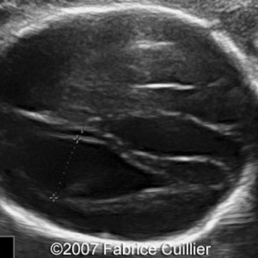 📃 Interhemispheric cyst, agenesis of the corpus callosum