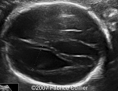 📃 Interhemispheric cyst, agenesis of the corpus callosum