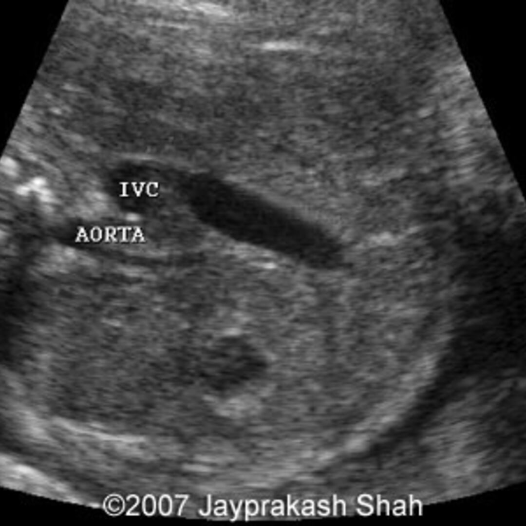 📃 Ductus venosus agenesis