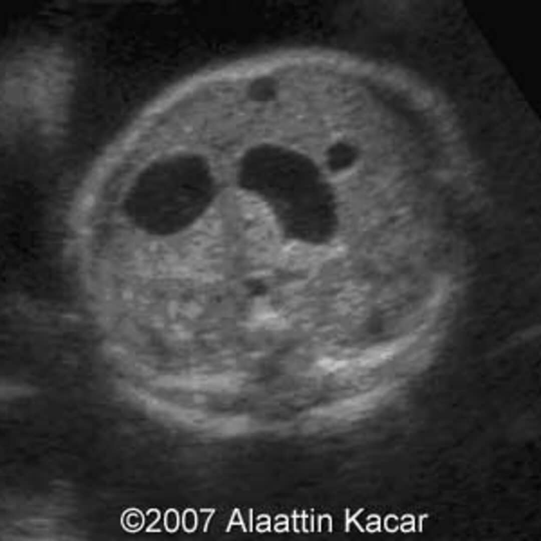 📃 Duodenal Atresia