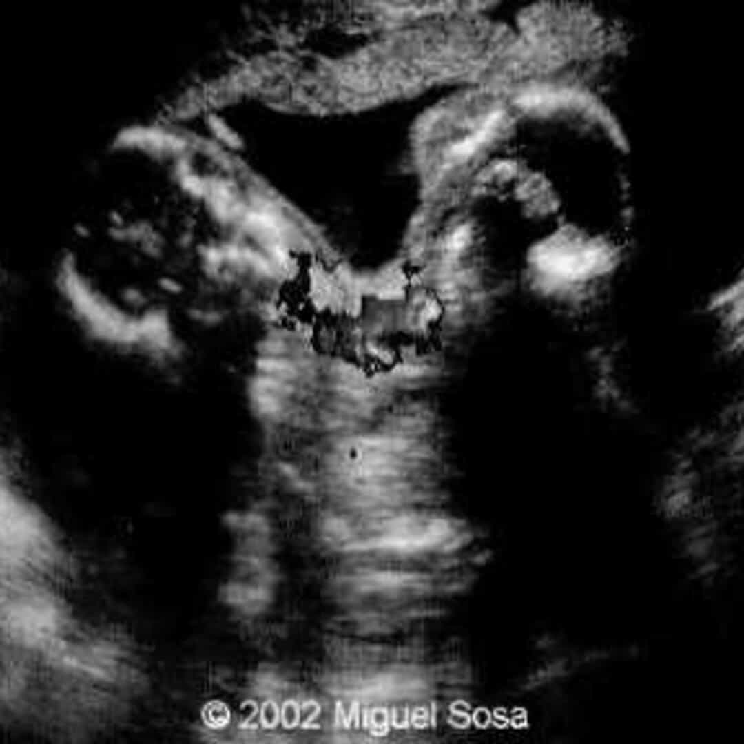 📃 Twins, conjoined