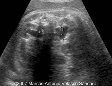 📃 Pyelectasis, bilateral and hydrocele