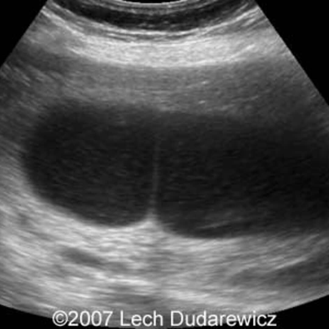📃 Asherman syndrome, uterine synechia