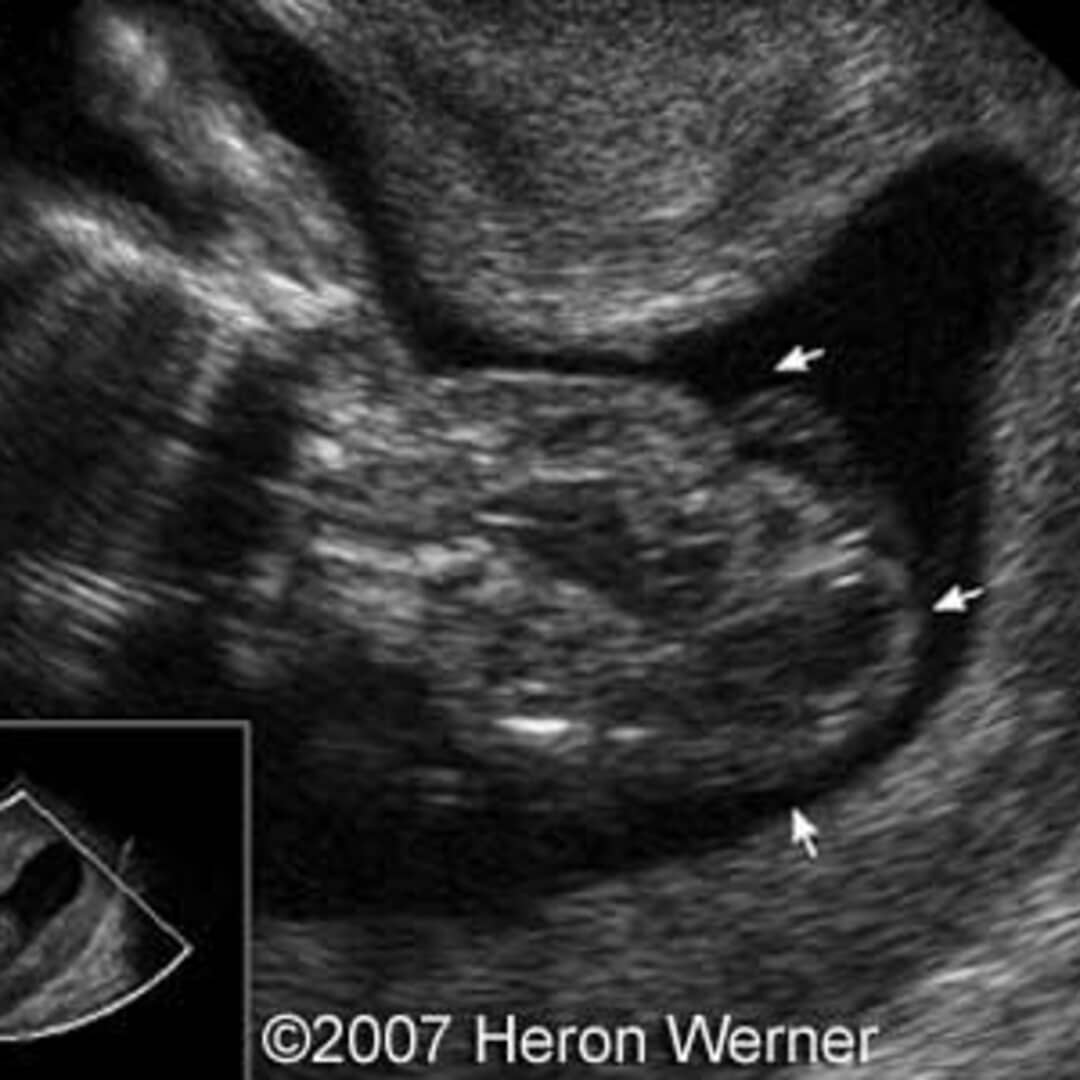 📃 Acrania, 13 weeks