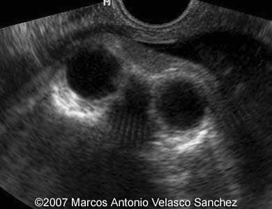 📃 Acrania, craniorachischisis, 36 weeks