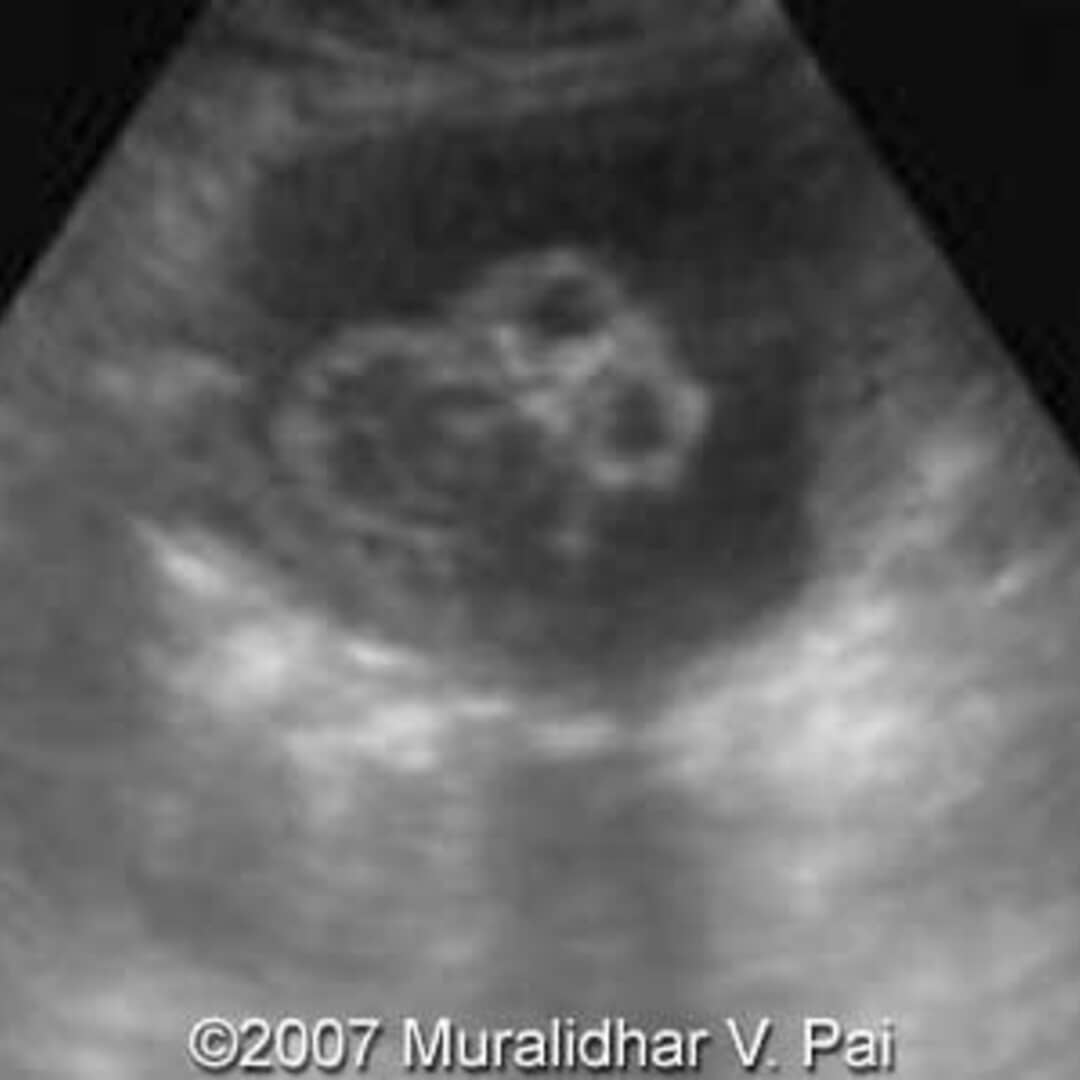 📃 Acrania and craniorachischisis