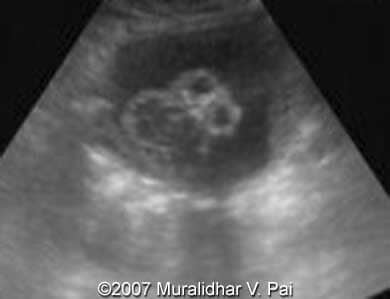 📃 Acrania and craniorachischisis