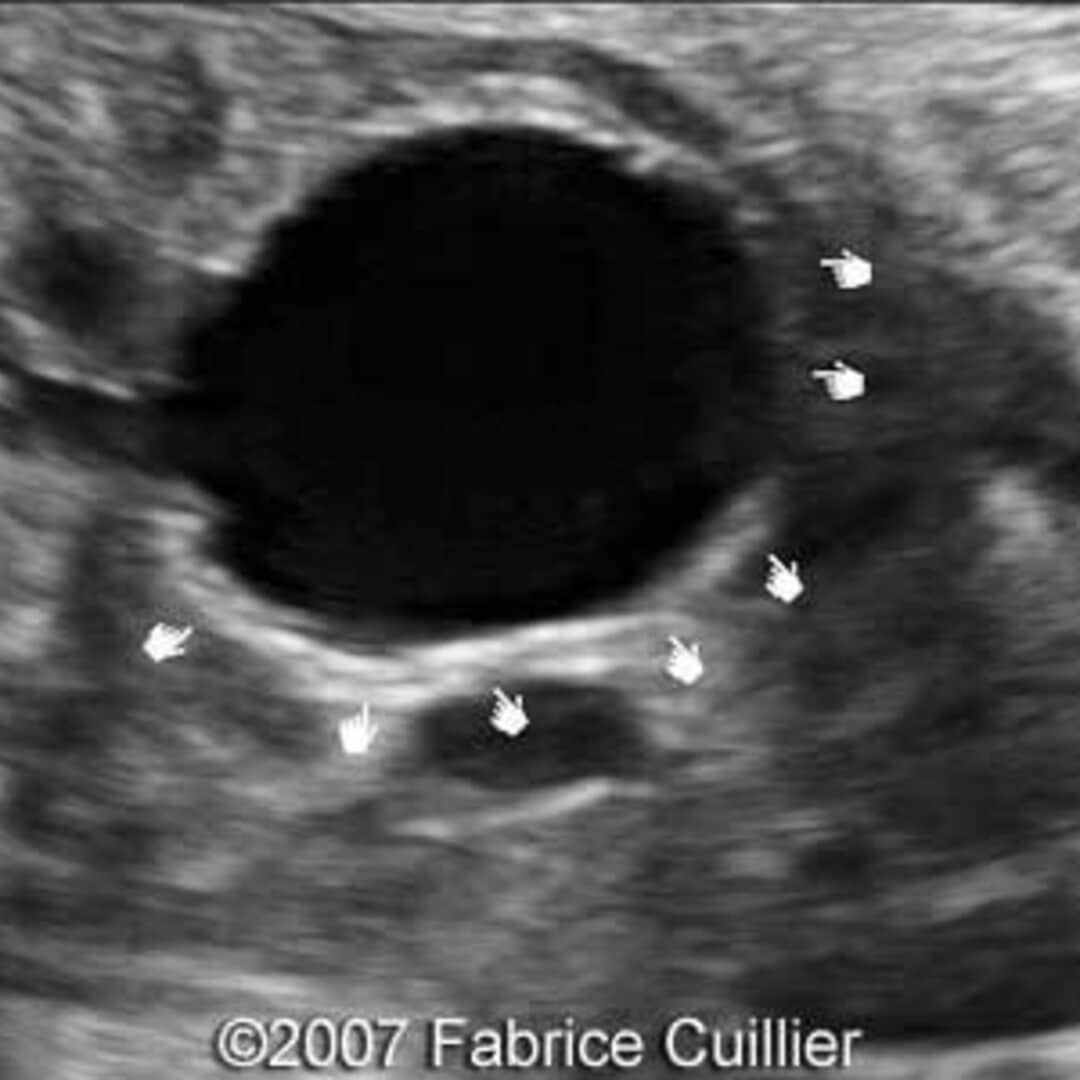 Keyhole Sign Posterior Urethral Valves at Nita Myers blog