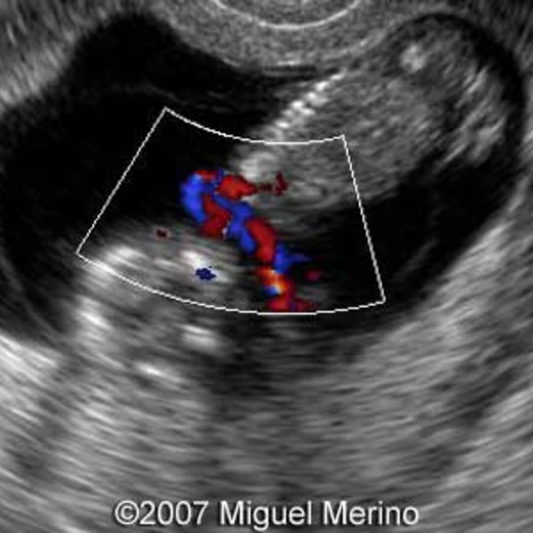 📃 Umbilical cord around the fetal neck