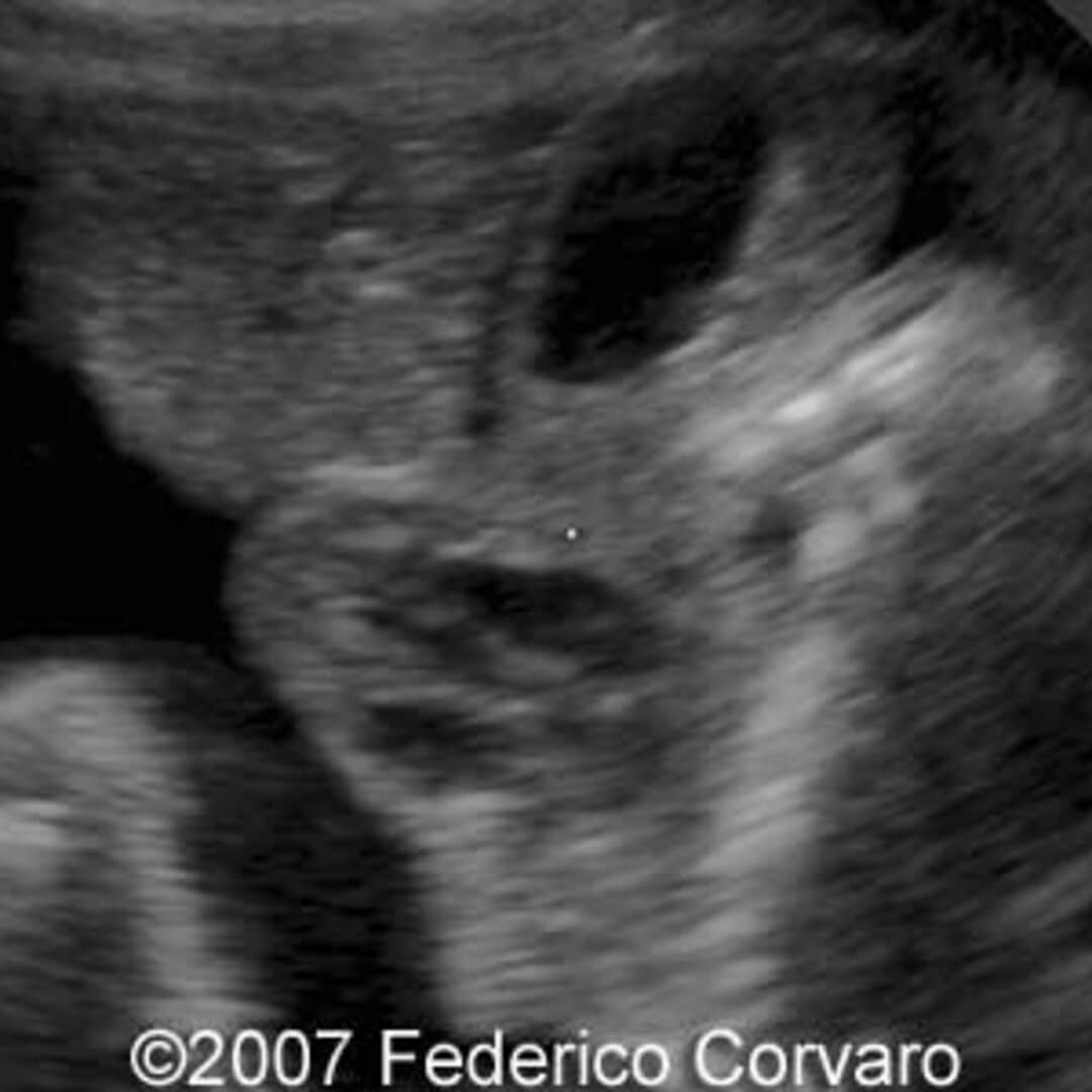 Síndrome De Body Stalk - RETOEDU