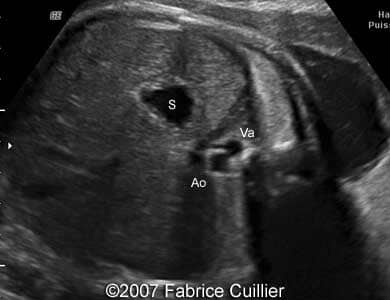 📃 Visceral situs inversus