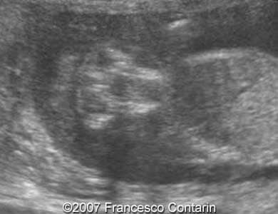 📃 Anencephaly