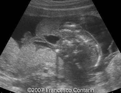 📃 Limb body stalk anomaly