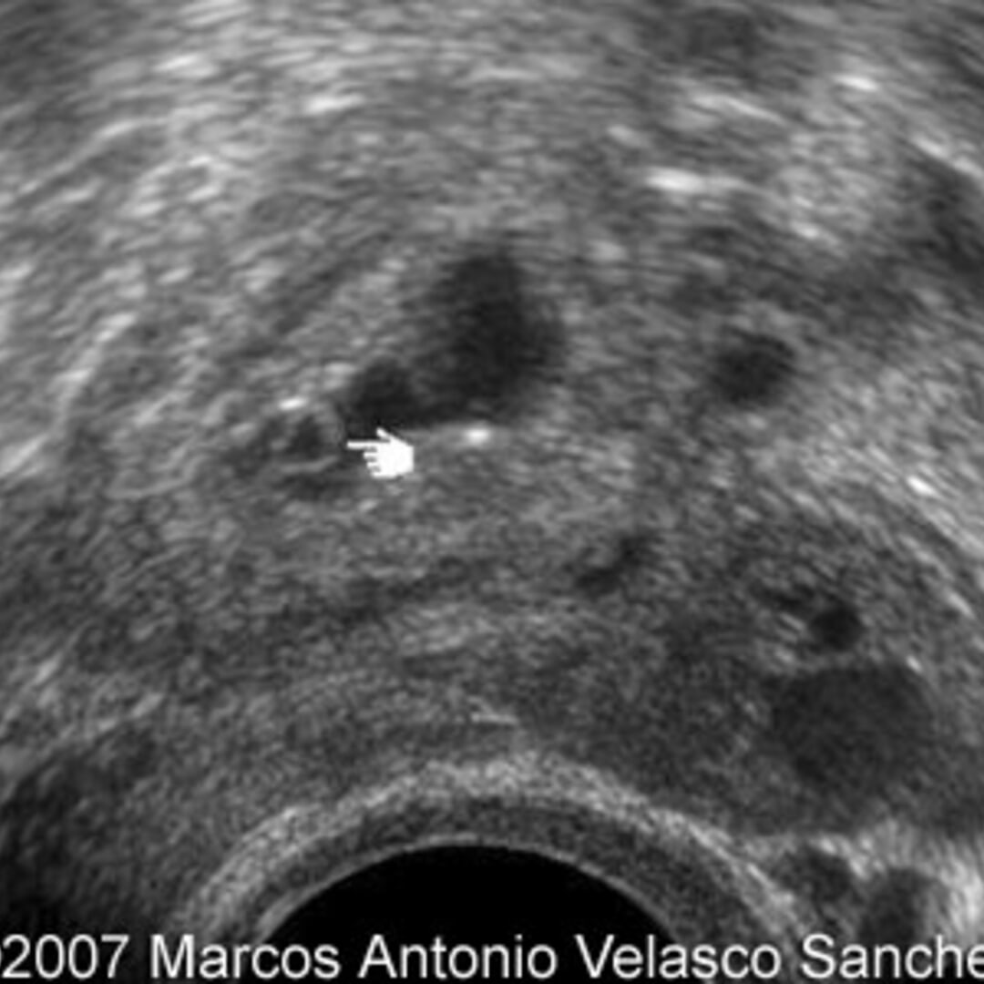 📃 Extrauterine pregnancy, tubal