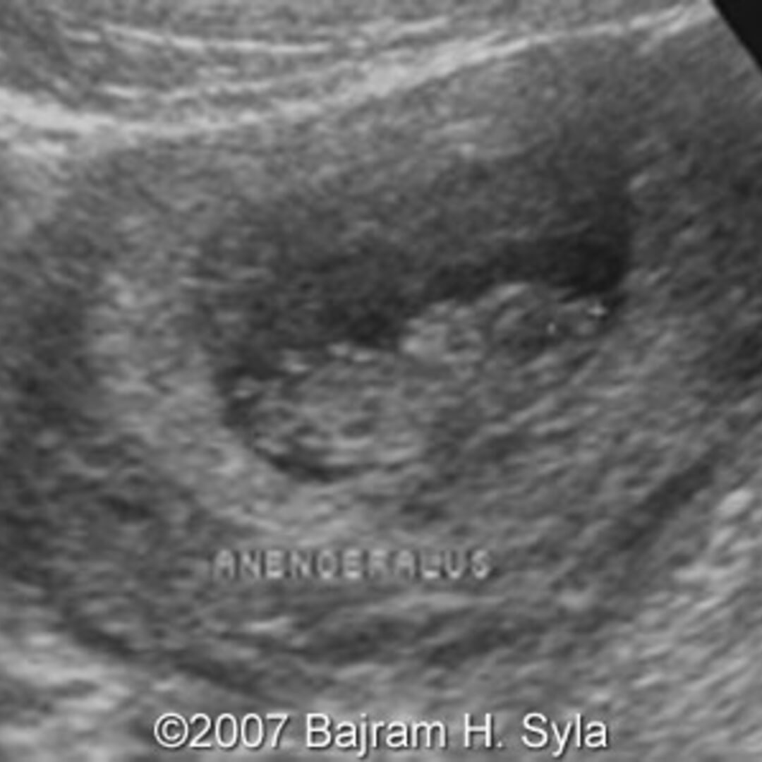 📃 Acrania, 12 weeks