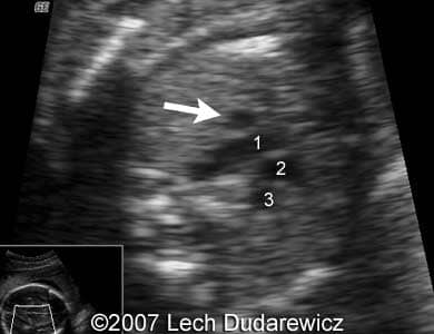 📃 Persistent left superior vena cava