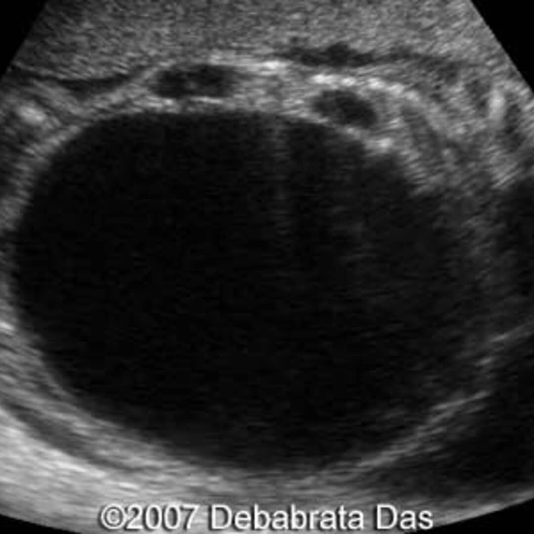 📃 Urethral atresia