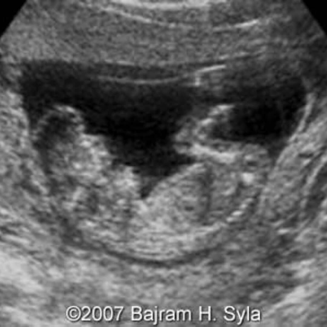 📃 Amniotic Band Syndrome