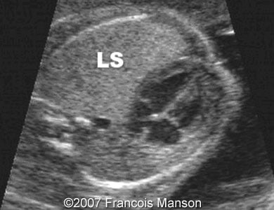 📃 Left lung sequestration, extralobar, intrathoracic