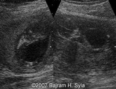 📃 Urethral atresia
